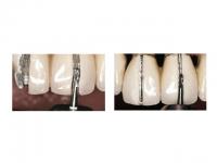 crown separator H4MCL | CrocoDental.eu